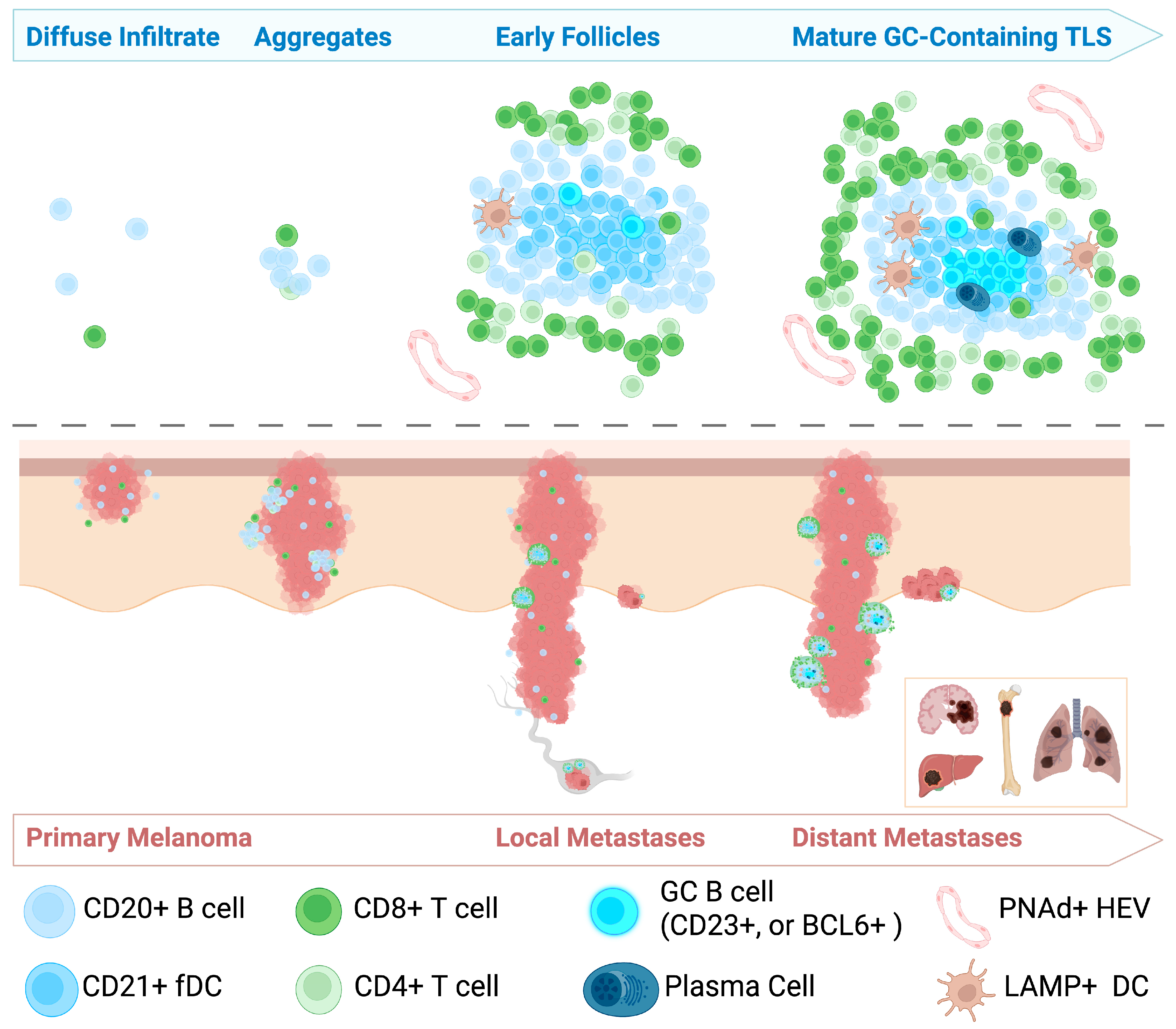 Tertiary Lymphoid Structures in Human Melanoma: Molecular Mechanisms ...