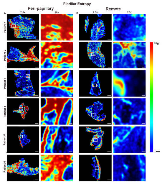 Collagen Fiber Maturity and Architecture in MVP-Associated Fibrosis ...