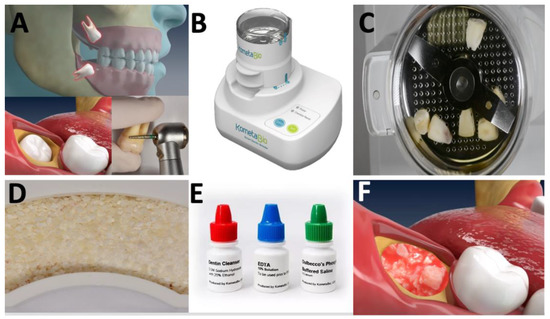 Tooth-Derived Matrix Granules for Enhanced Bone Healing: Chemical ...