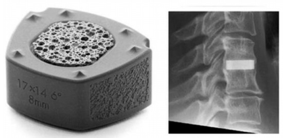 Non-Oxide Ceramics for Bone Implant Application: State-of-the-Art ...
