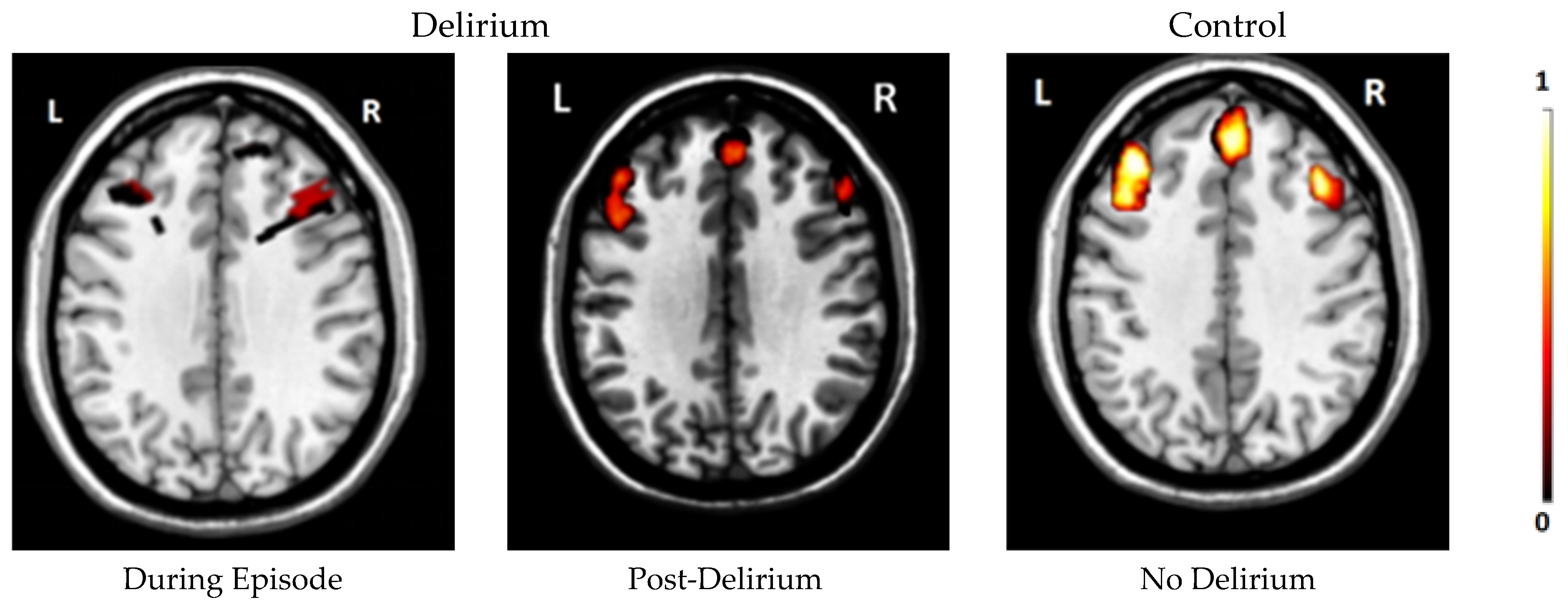 Investigating Sepsis-Associated Delirium Through Optical Neuroimaging ...