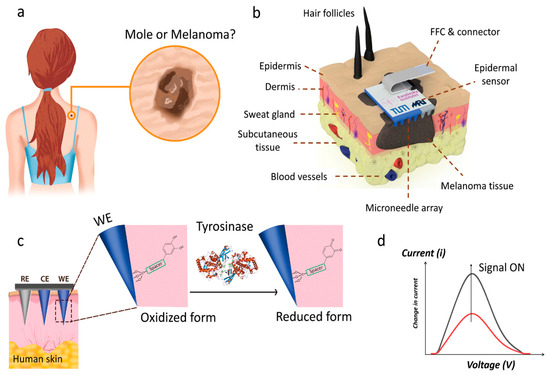 Microneedle-Based Sensors for Wearable Diagnostics