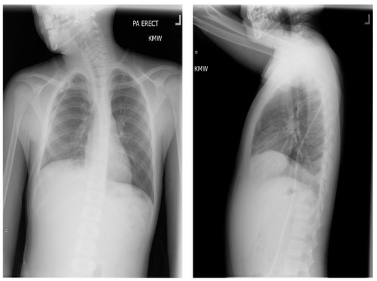 Use of Pleuroperitoneal Shunt in Chylothorax Related to Central Line ...