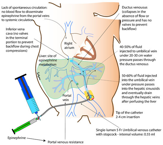 Epinephrine in Neonatal Resuscitation