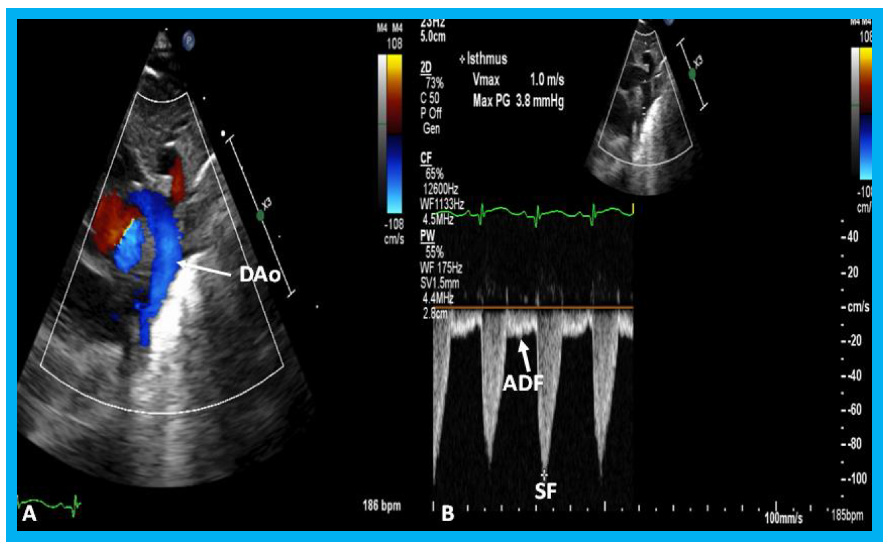 Suprasternal Short Axis View Echo | Video Bokep Ngentot