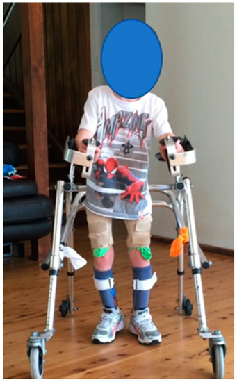 Sensomotoric Orthoses, Ankle–Foot Orthoses, and Children with Cerebral ...