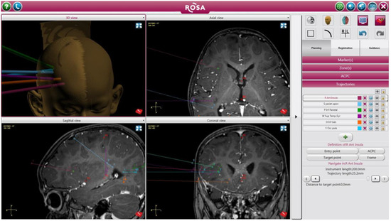 Robotic Stereotactic Assistance (ROSA) for Pediatric Epilepsy: A Single ...