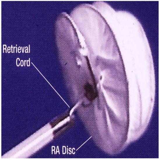 Children | Free Full-Text | Outcomes of Device Closure of Atrial Septal ...