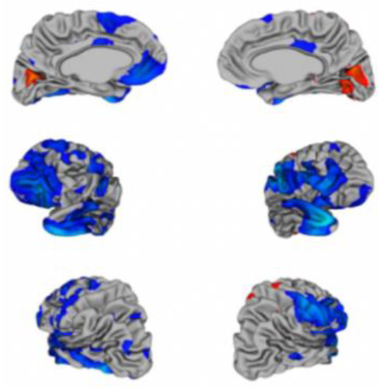 An Autoencoder Based Deep Learning Classifier For Efficient Diagnosis Of Autism