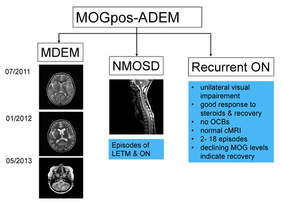 Acute Disseminated Encephalomyelitis: Current Perspectives