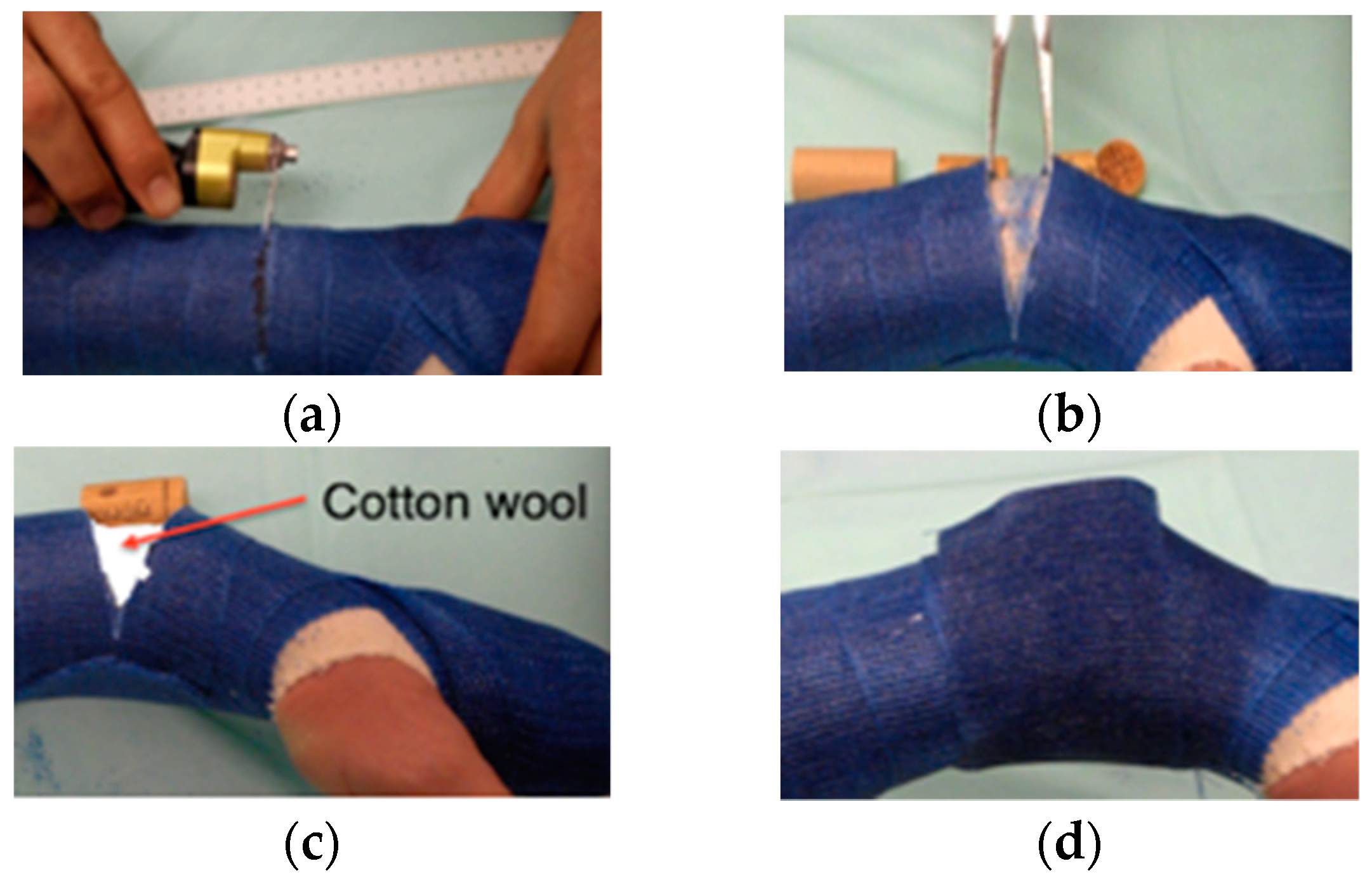 Children | Free Full-Text | Pain during Cast Wedging of Forearm Shaft ...