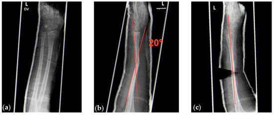 Pain during Cast Wedging of Forearm Shaft and Distal Forearm Fractures ...