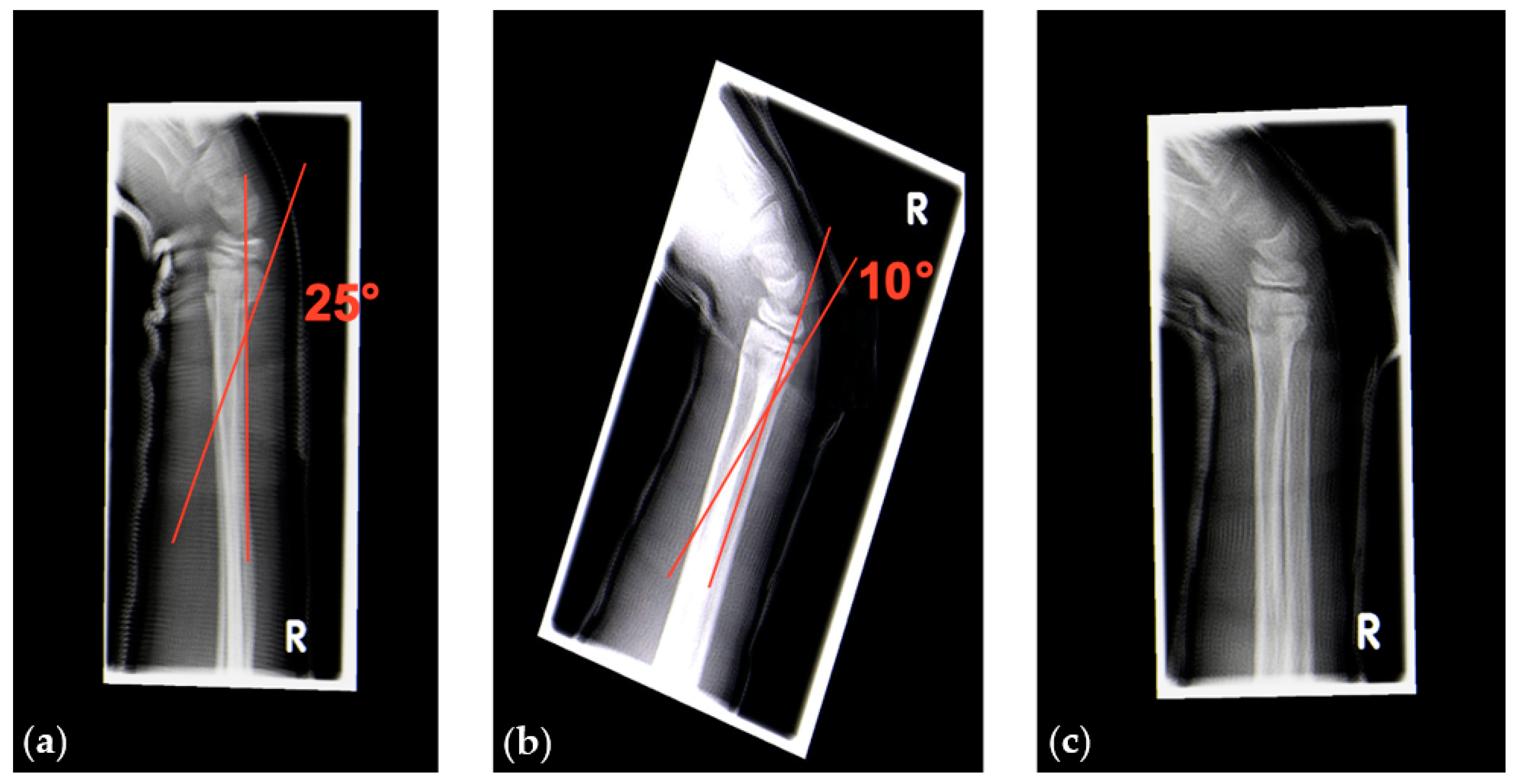 Pain during Cast Wedging of Forearm Shaft and Distal Forearm Fractures ...