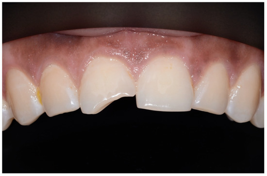 Restoration of an Upper Anterior Tooth in an Adolescent with Autism ...
