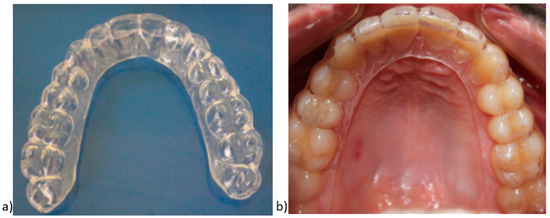 The Behavior of Two Types of Upper Removable Retainers—Our Clinical ...