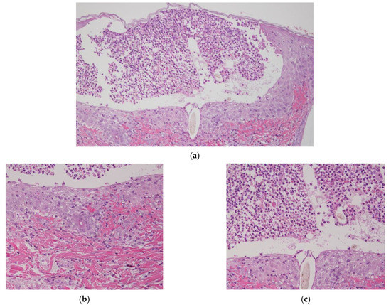 Erythema Toxicum Neonatorum Histology