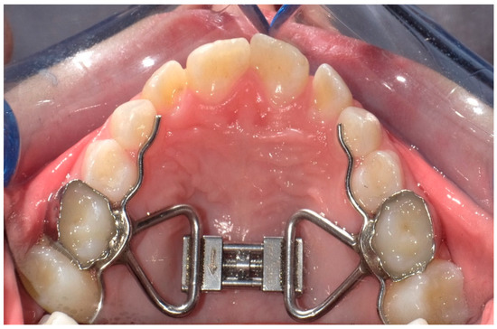 Safety and Effects of the Rapid Maxillary Expander on Temporomandibular ...