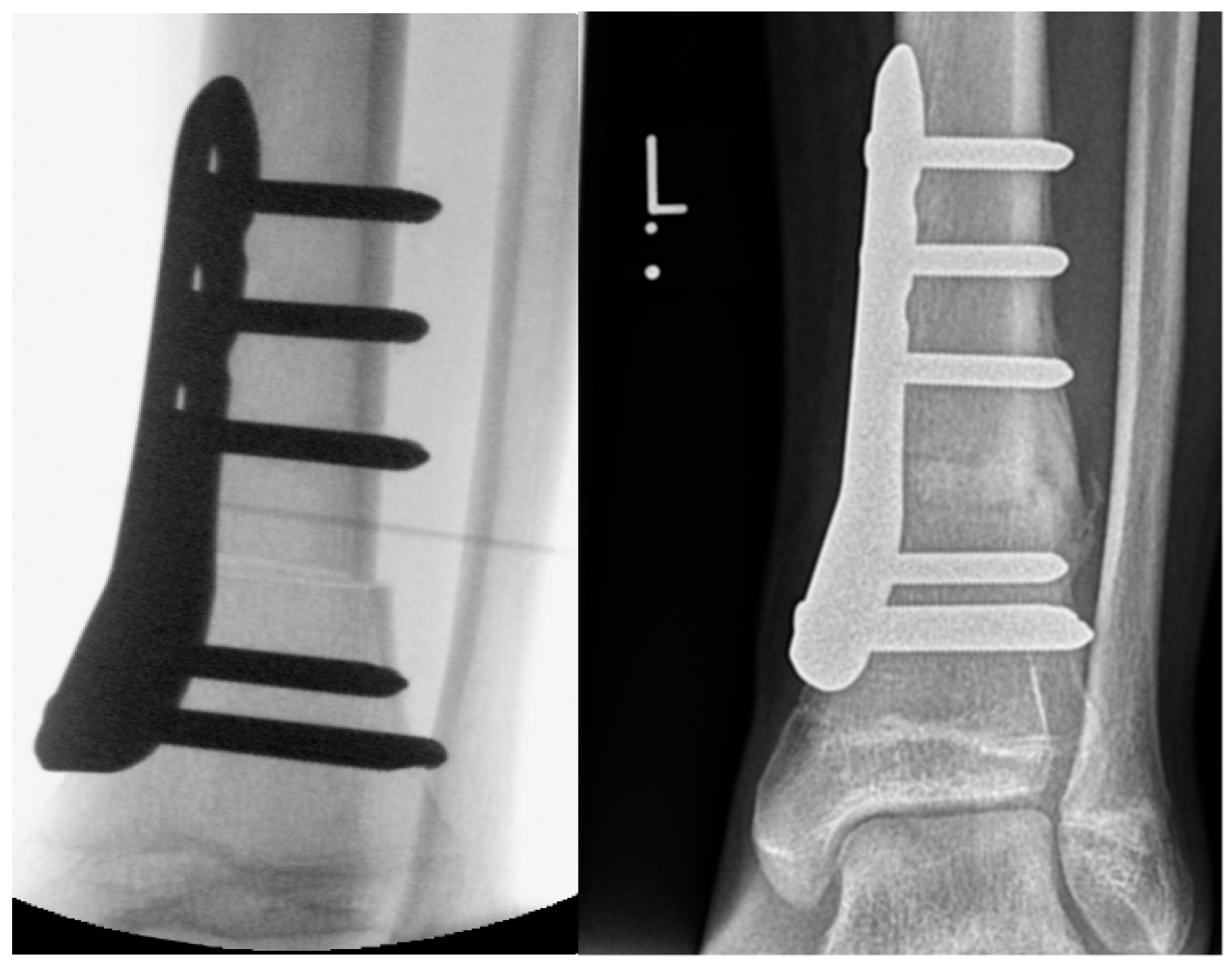 Children | Free Full-Text | Differences between Two Methods to ...