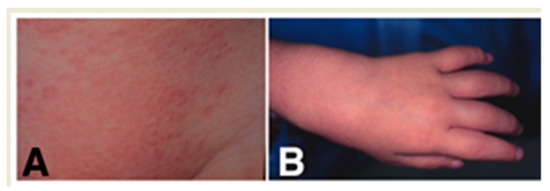 NOD2 Mutation-Associated Case with Blau Syndrome Triggered by BCG ...