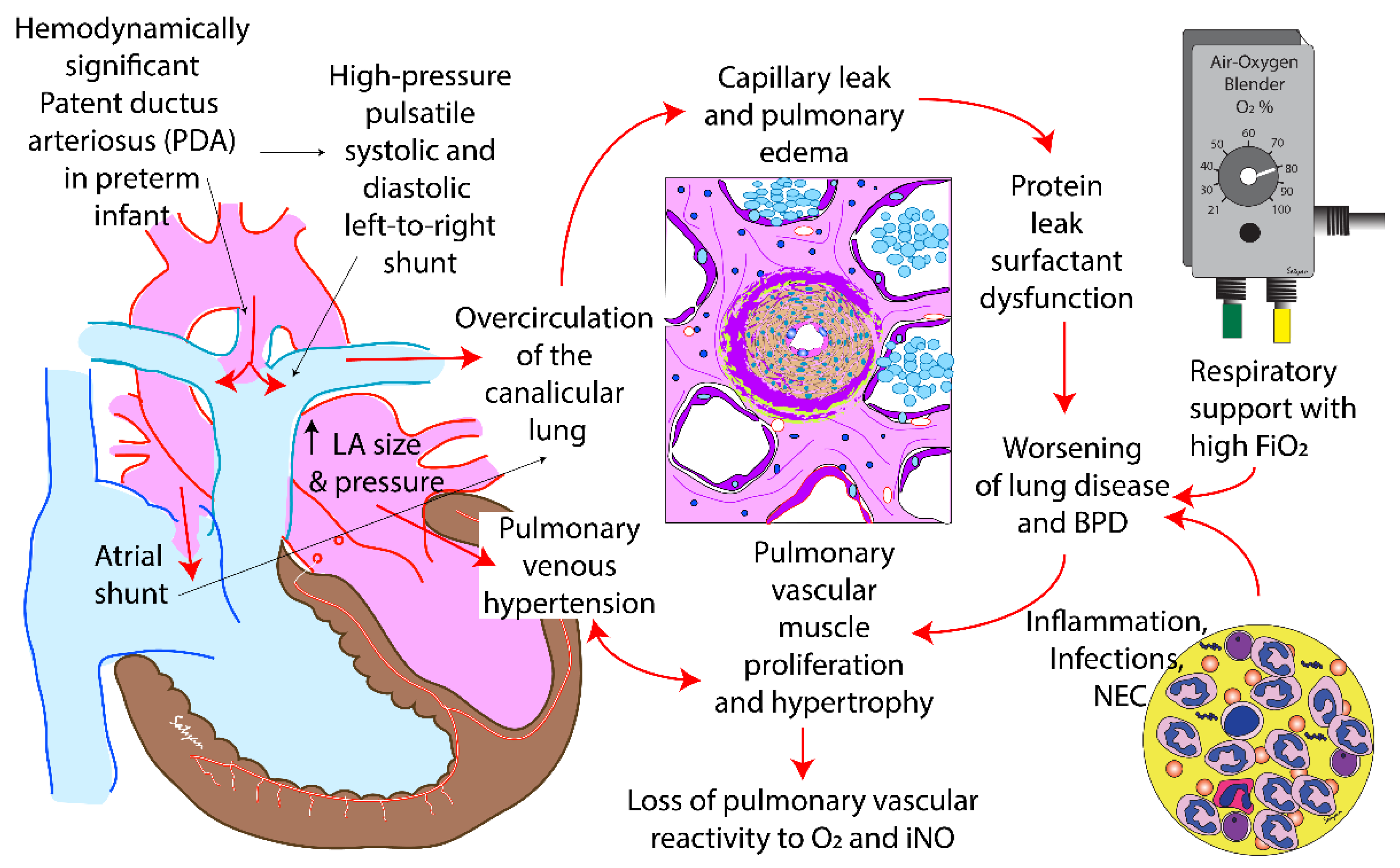 Neonatal and Postneonatal Pulmonary Hypertension