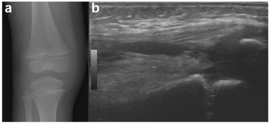 Pediatric Septic Arthritis of the Knee Due to a Multi-Sensitive ...