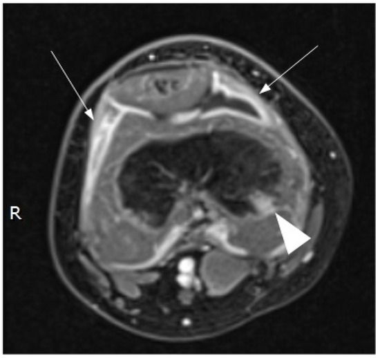 Pediatric Septic Arthritis of the Knee Due to a Multi-Sensitive ...