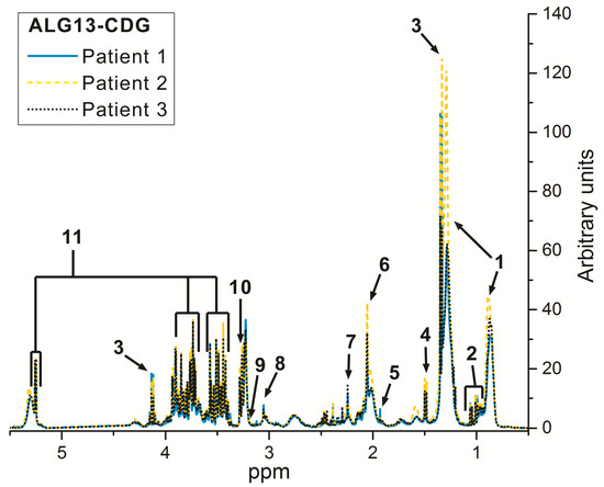 The First Metabolome Analysis in Children with Epilepsy and ALG13-CDG Resulting from c.320A>G ...