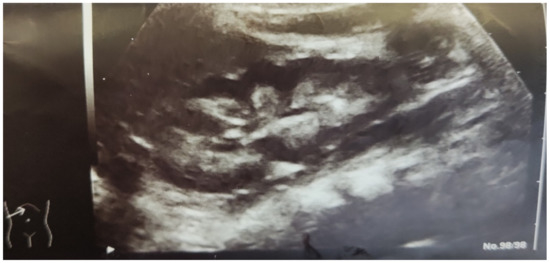 Subcutaneous Fat Necrosis and Hypercalcemia with Nephrocalcinosis in ...