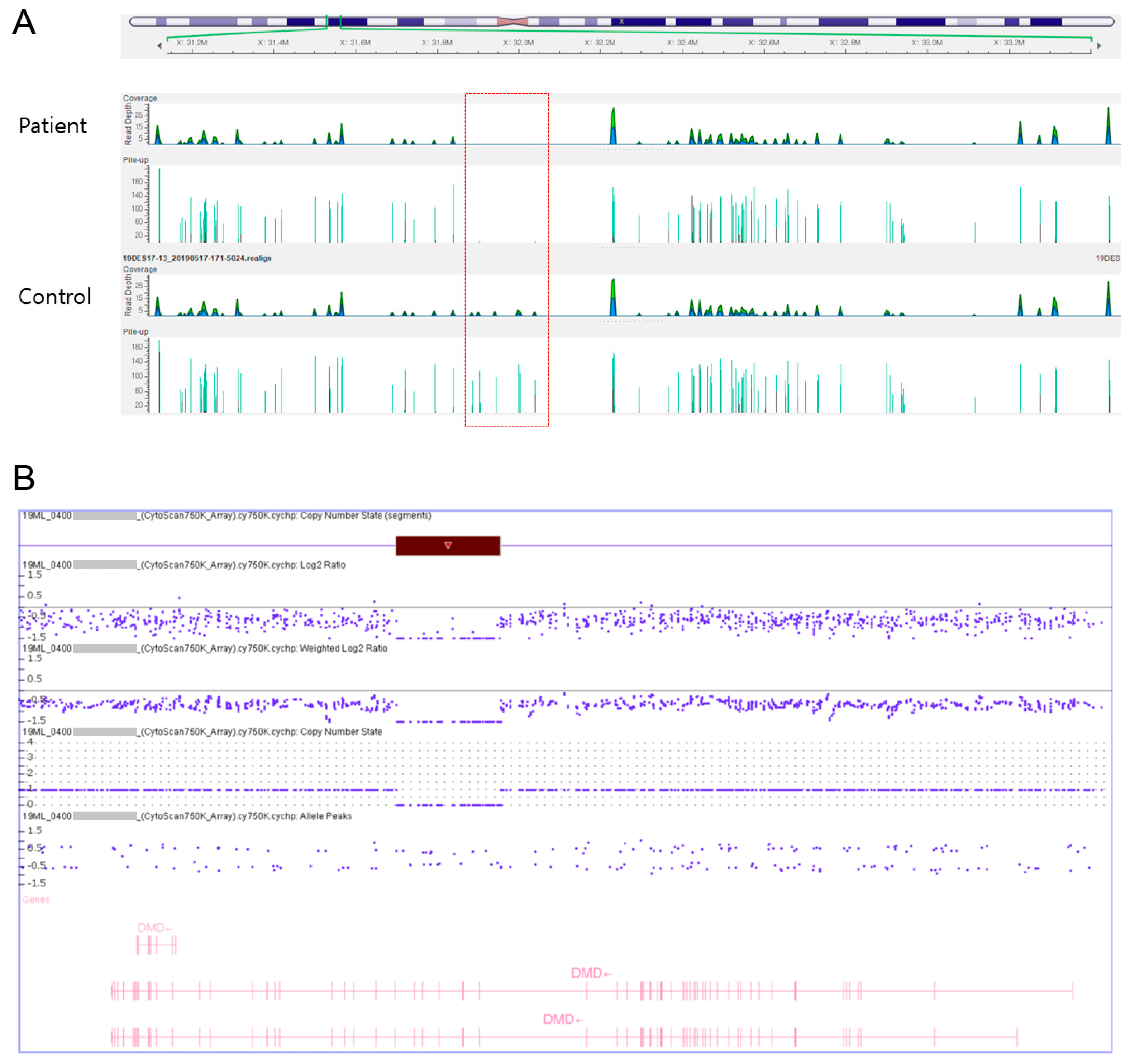 Diagnosis of Duchenne Muscular Dystrophy in a Presymptomatic Infant ...