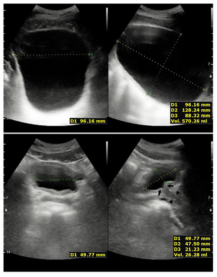 Prolonged Indwelling Urethral Catheterization as Minimally Invasive ...