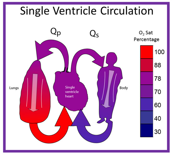 Single Ventricle—A Comprehensive Review