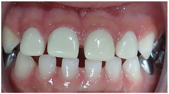 Parental and Dentist Satisfaction with Primary Anterior Zirconia Crowns ...