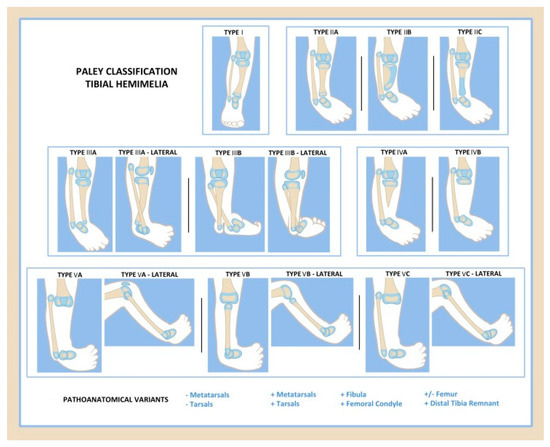 Deformity Reconstruction Surgery for Tibial Hemimelia