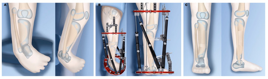 Deformity Reconstruction Surgery for Tibial Hemimelia