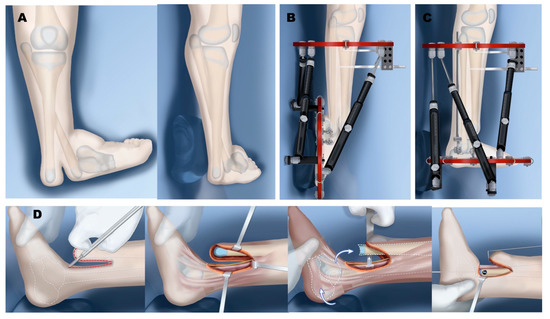Deformity Reconstruction Surgery for Tibial Hemimelia