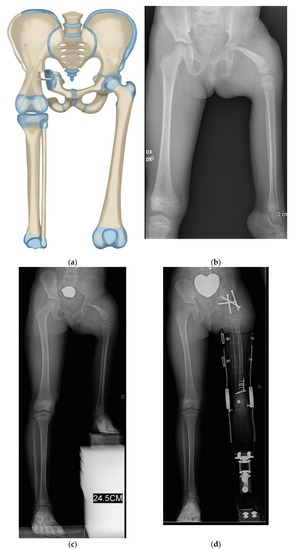 Children | Free Full-Text | Rotationplasty for Severe Congenital ...