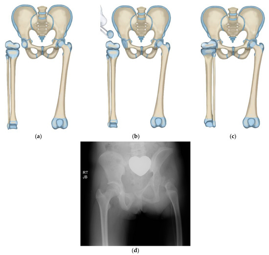 Children | Free Full-Text | Rotationplasty for Severe Congenital ...