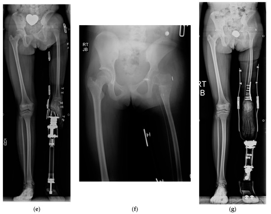Children | Free Full-Text | Rotationplasty for Severe Congenital ...