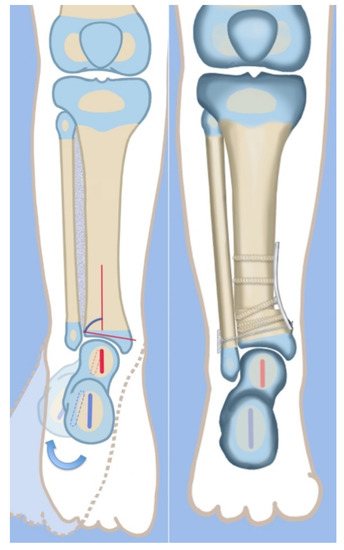 Fibular Hemimelia Limb Lengthening