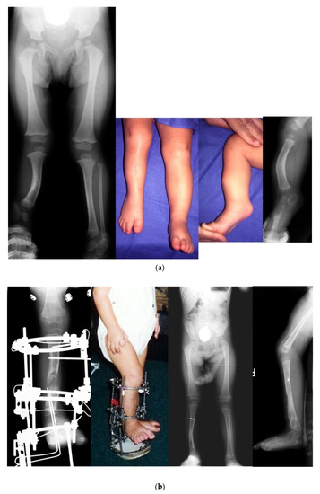 Lengthening Reconstruction Surgery for Fibular Hemimelia: A Review