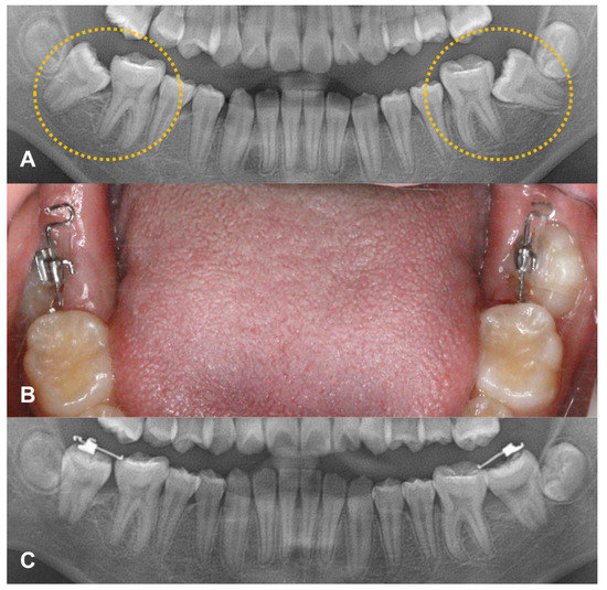 The Piston Elastic: A Novel Device for Treating Entrapped Ectopic ...