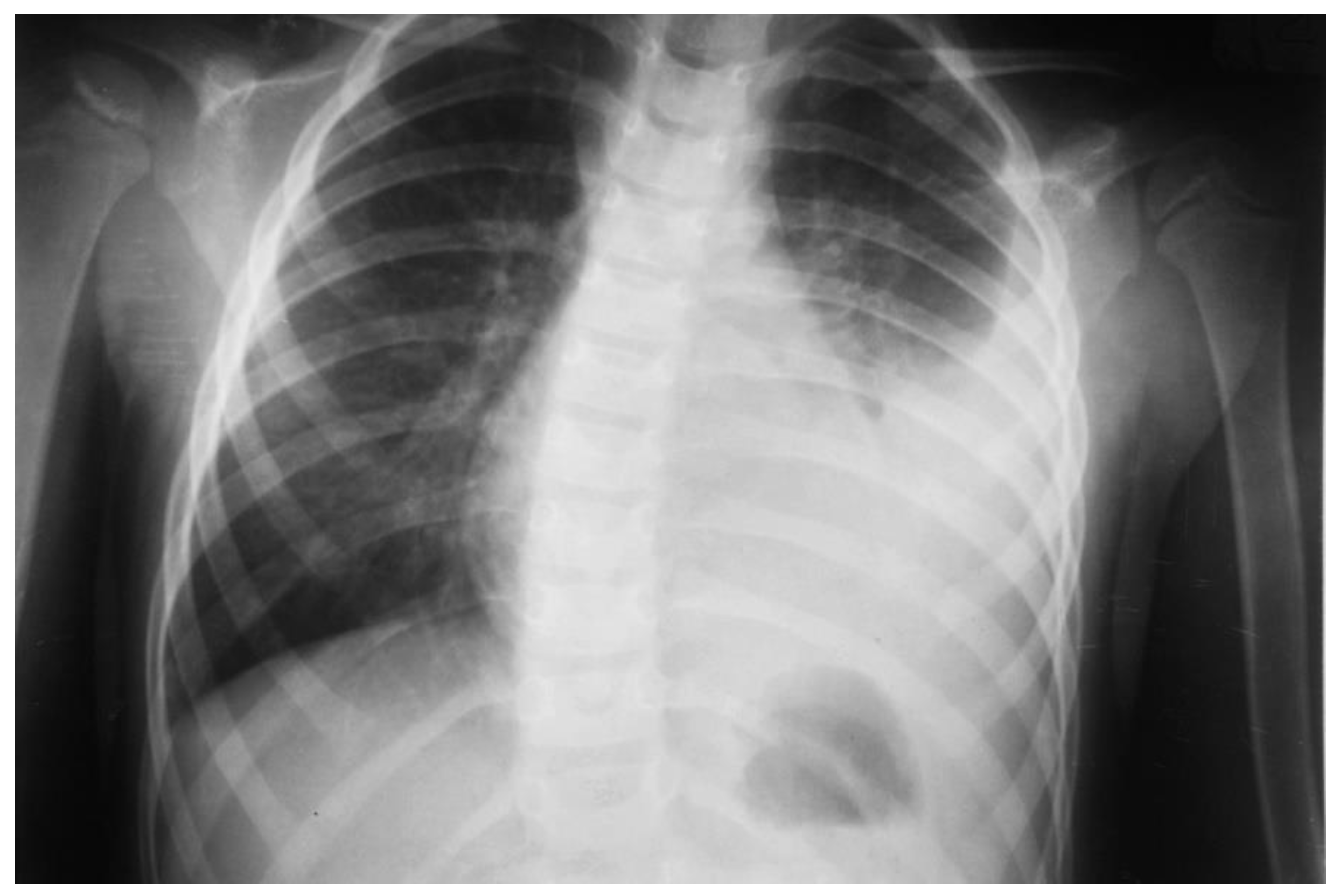 Children | Free Full-Text | Lung Ultrasound Is More Sensitive for ...