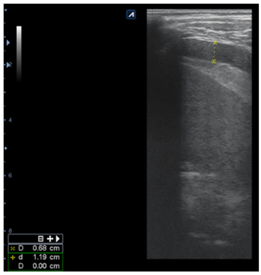 Children | Free Full-Text | Lung Ultrasound Is More Sensitive for ...