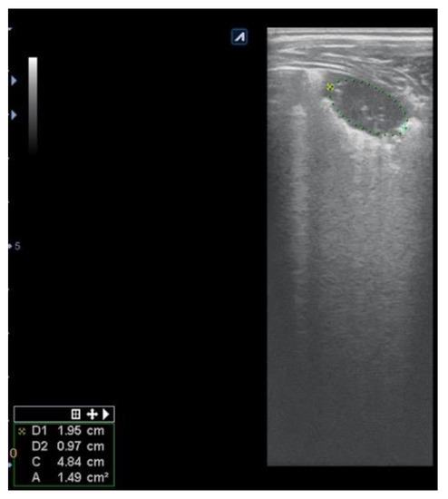 Children | Free Full-Text | Lung Ultrasound Is More Sensitive for ...