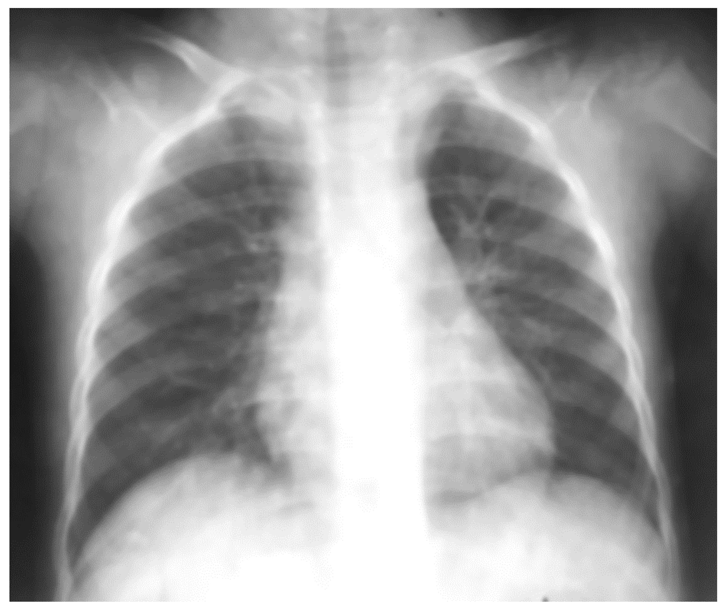 Children | Free Full-Text | Lung Ultrasound Is More Sensitive for ...