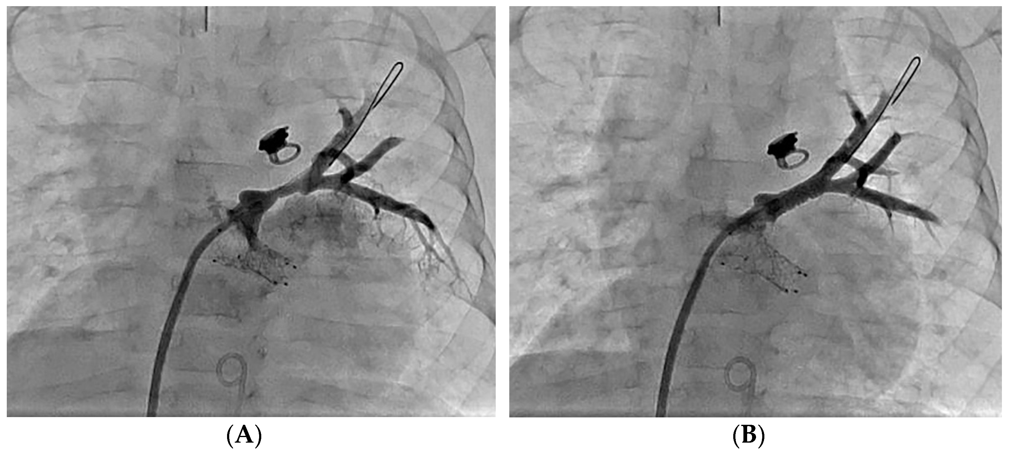 Pulmonary Vein Stenosis in Children: A Programmatic Approach Employing ...