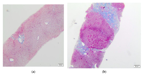 Liver Histopathology in Late Protocol Biopsies after Pediatric Liver ...