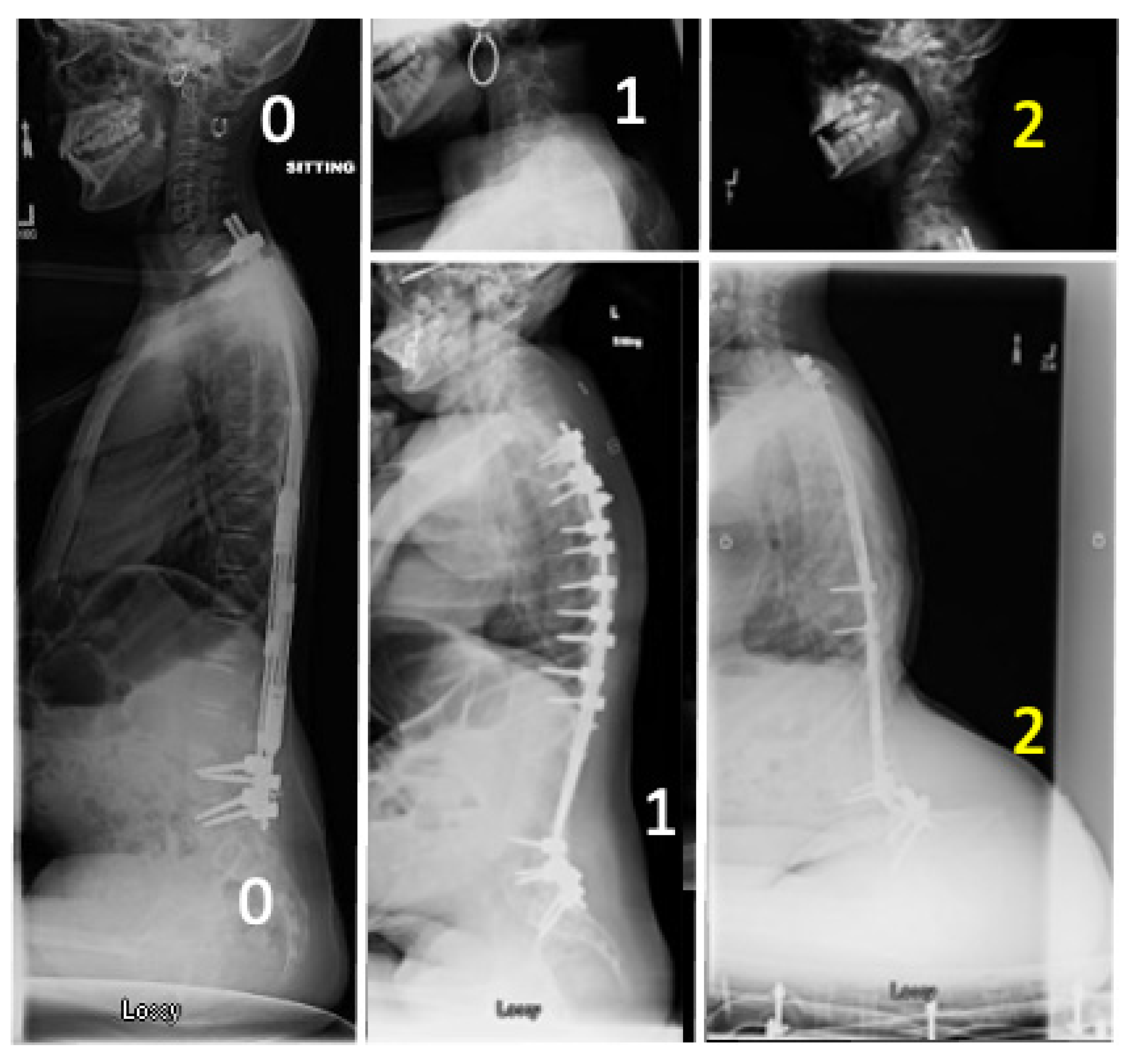 Sagittal Plane Deformities in Children with SMA2 following Posterior ...