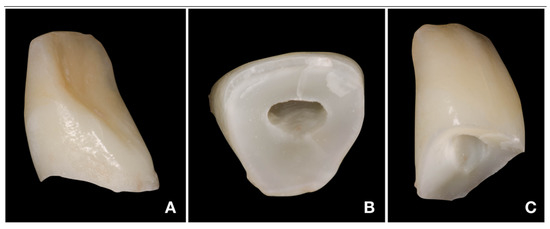 Conservative Treatment of Complicated Crown Fracture and Crown-Root ...