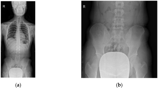 Is Longstanding Congenital Muscular Torticollis Provoking Pelvic ...